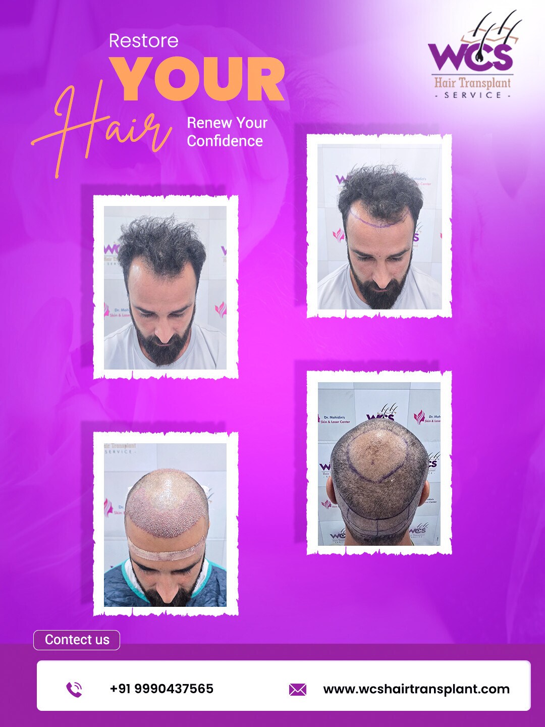 Wcs Hair Transplant Service in Jasola Vihar,Delhi - Best near me in ...